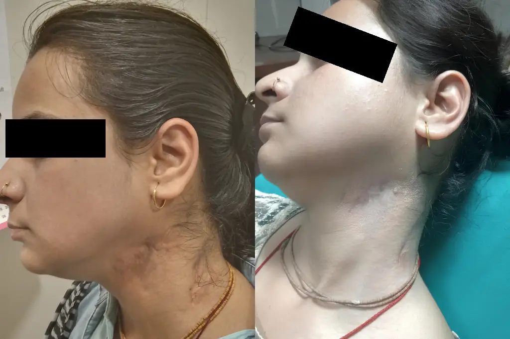 Laser Hair Removal AD | Perfect Point